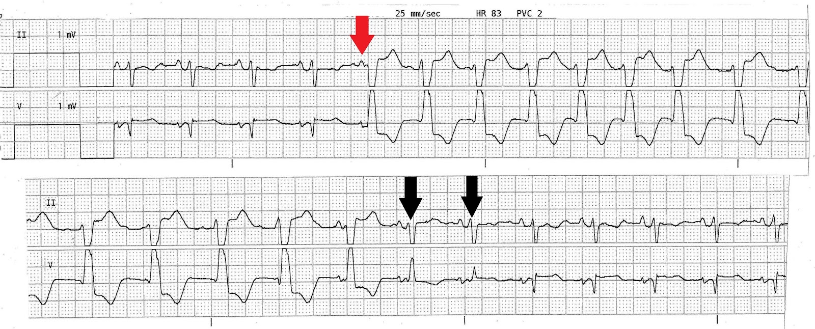 ECG Rhythms: AIVR/VT or Aberrancy?