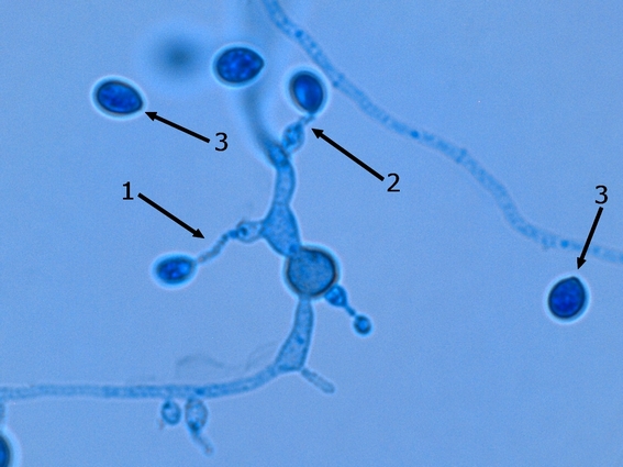 Fun With Microbiology (What's Buggin' You?): Scedosporium prolificans