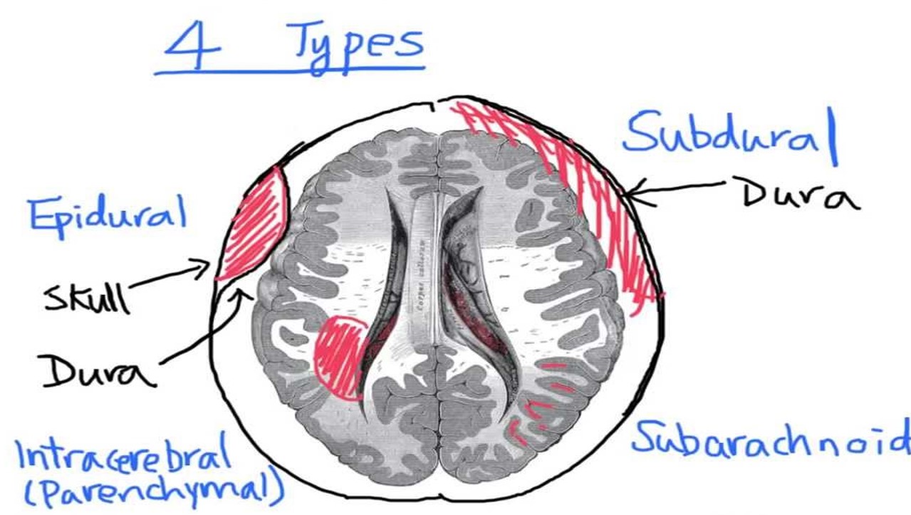 Mayra Lopes: Hematoma Subdural