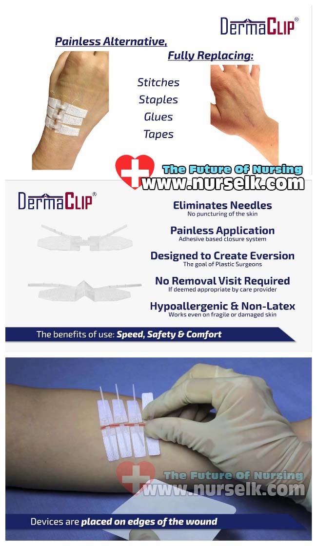 DermaClip Non-Invasive Skin Closure Device | Nurselk.com