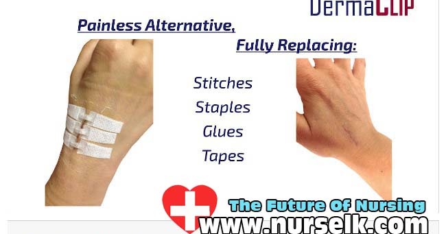 DermaClip Non-Invasive Skin Closure Device | Nurselk.com