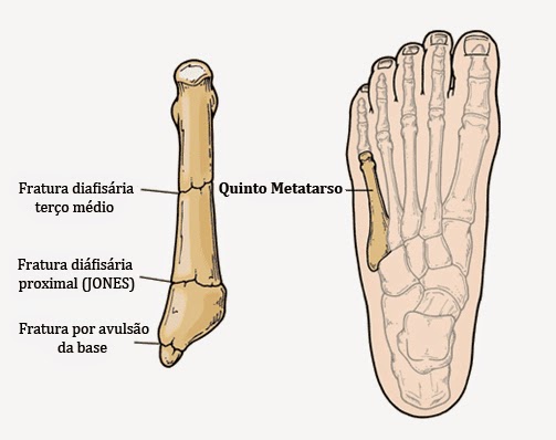 RL: Fratura em Base do 5º Metatarso