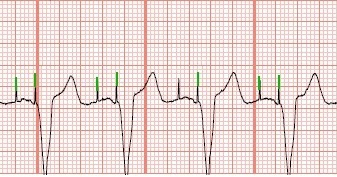 EKG Rhythm Strip Quiz 26
