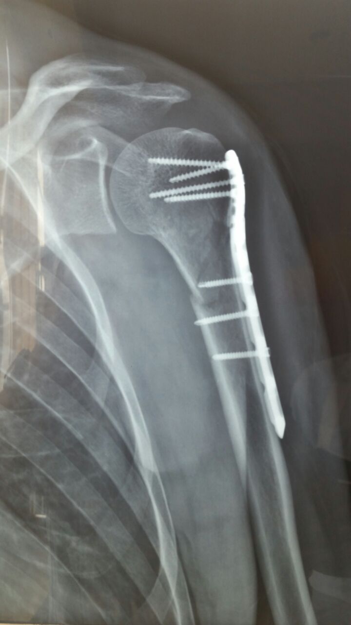 Revisiones_bibliográficas TyO_Web: Fractura de húmero proximal