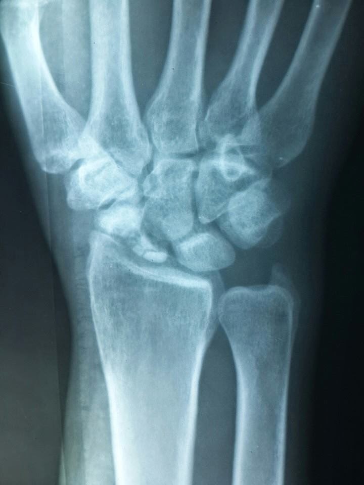 Cirugía de Mano y Traumatología: Discusión entre pares_25 years male ...