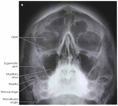 FACIAL BONES X RAY | PARIETOACANTIAL PROJECTION - RadTechOnDuty