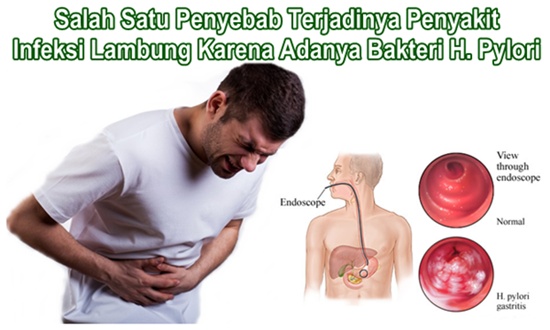 Pengobatan Herbal Infeksi Lambung Terbaik - Cara Mengobati Penyakit Alami
