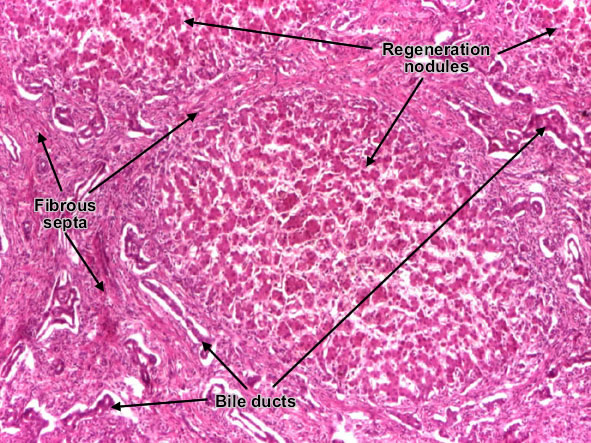 موقع الدكتور أحمد كلحى: صور باثولوجى - Patholgy Slides : Liver, Biliary ...