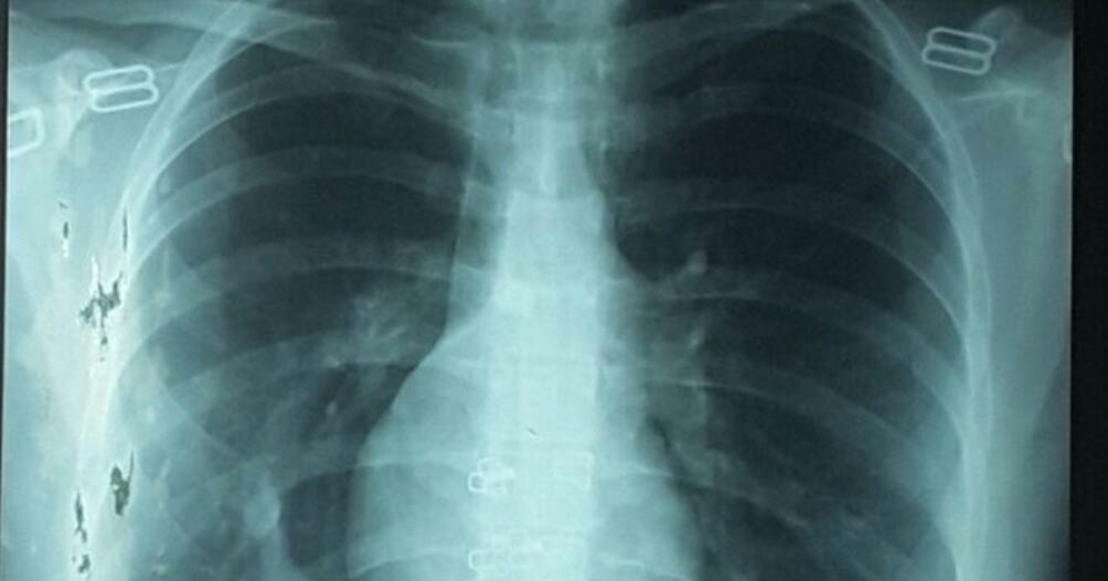 Mild chest discomfort (thorax)