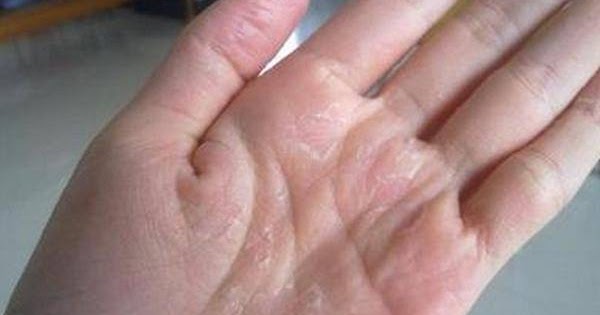 Sering Muncul Bintik Air yang Gatal dan Sakit?! Banyak Orang Gak Tahu ...