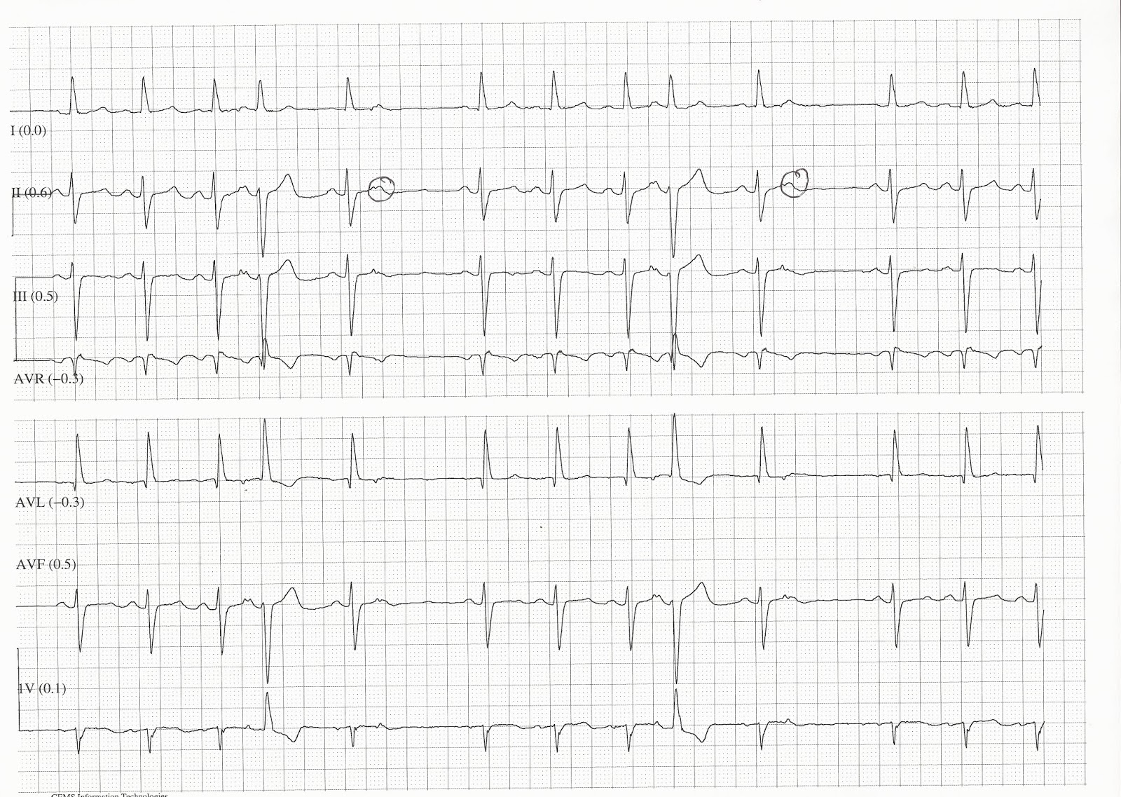 Bigeminal dropped PACs