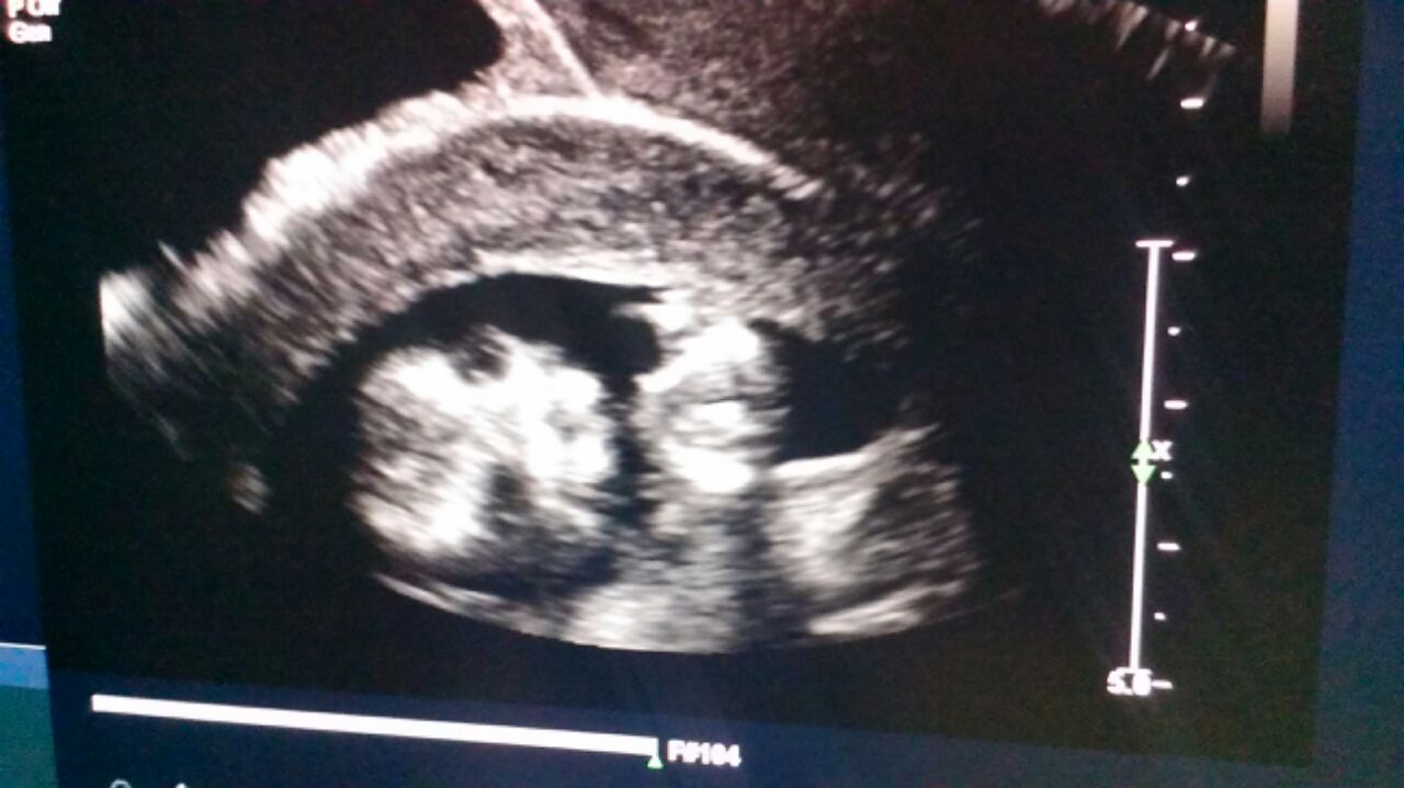 Wanderings of a Tactless Mind: Cora Ann -- A Story of Triploidy ...