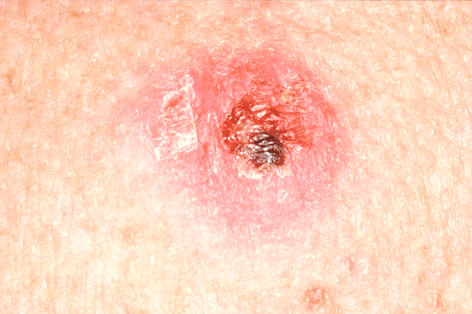 Skin Cancer Caused By Sun - What is Cancer