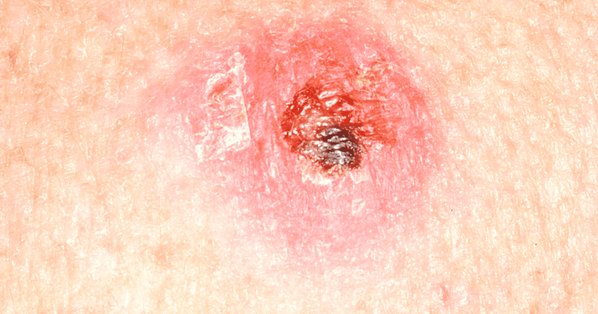 Skin Cancer Caused By Sun - What is Cancer
