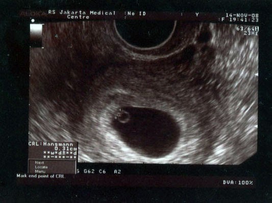 Ide 33+ USG 5 Minggu Kehamilan