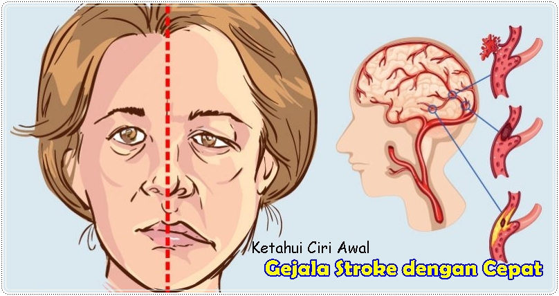 Ciri-ciri Gejala Stroke Ringan yang Perlu Anda Waspadai - Channel Media ... Ciri-ciri Gejala Stroke Ringan yang Perlu Anda Waspadai - Channel Media ...