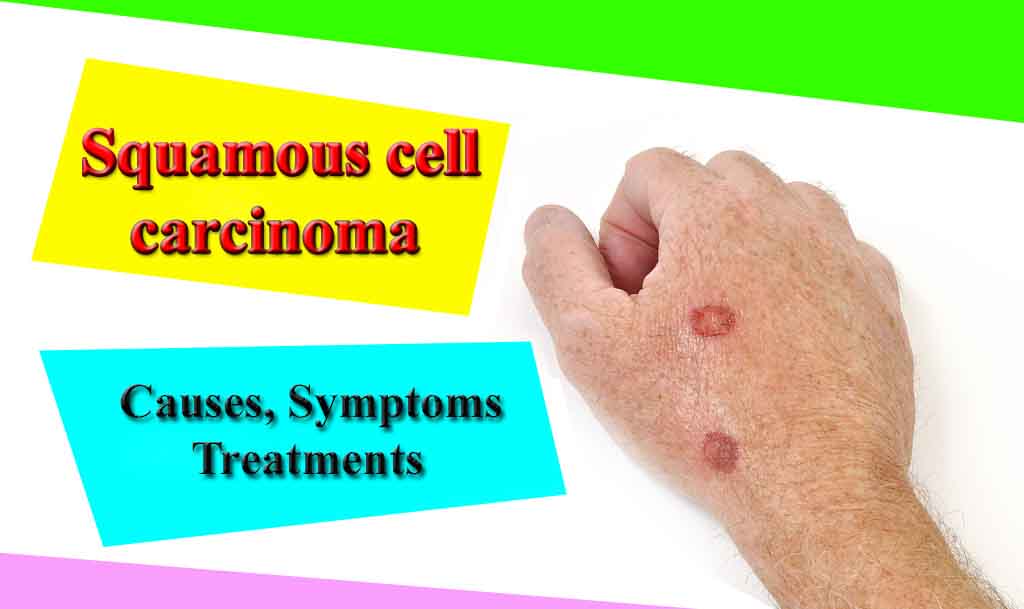 What Is Squamous Cell Carcinoma Of The Skin?