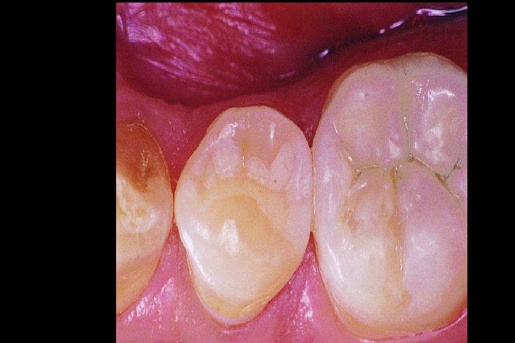 Resin komposit ~ Mine