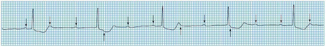 Third degree atrioventricular block / Complete heart block - ECG