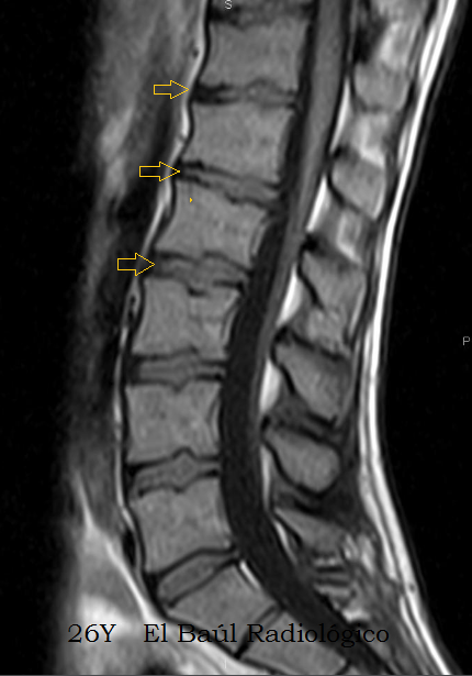 El Baúl Radiológico: ENFERMEDAD DE SCHEUERMANN (DORSALGIA JUVENIL ...