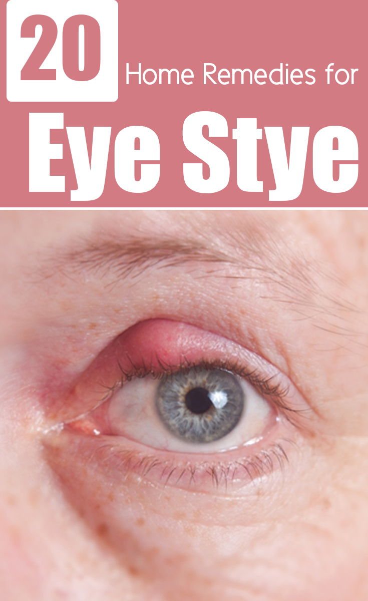 20 Effective Home Remedies For Eye Stye - Health Craze