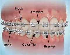 Mouth Emergencies with Braces