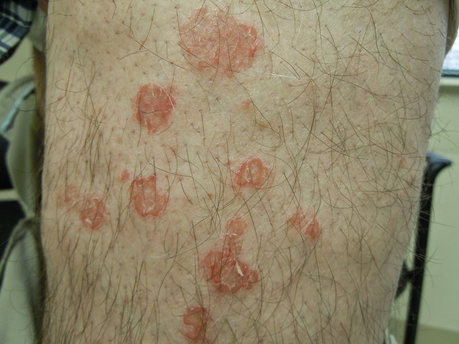 SKIN DISEASE TYPES: Nummular Dermatitis