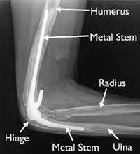 Medical Treatment Pictures-for Better Understanding: Elbow Replacement ...