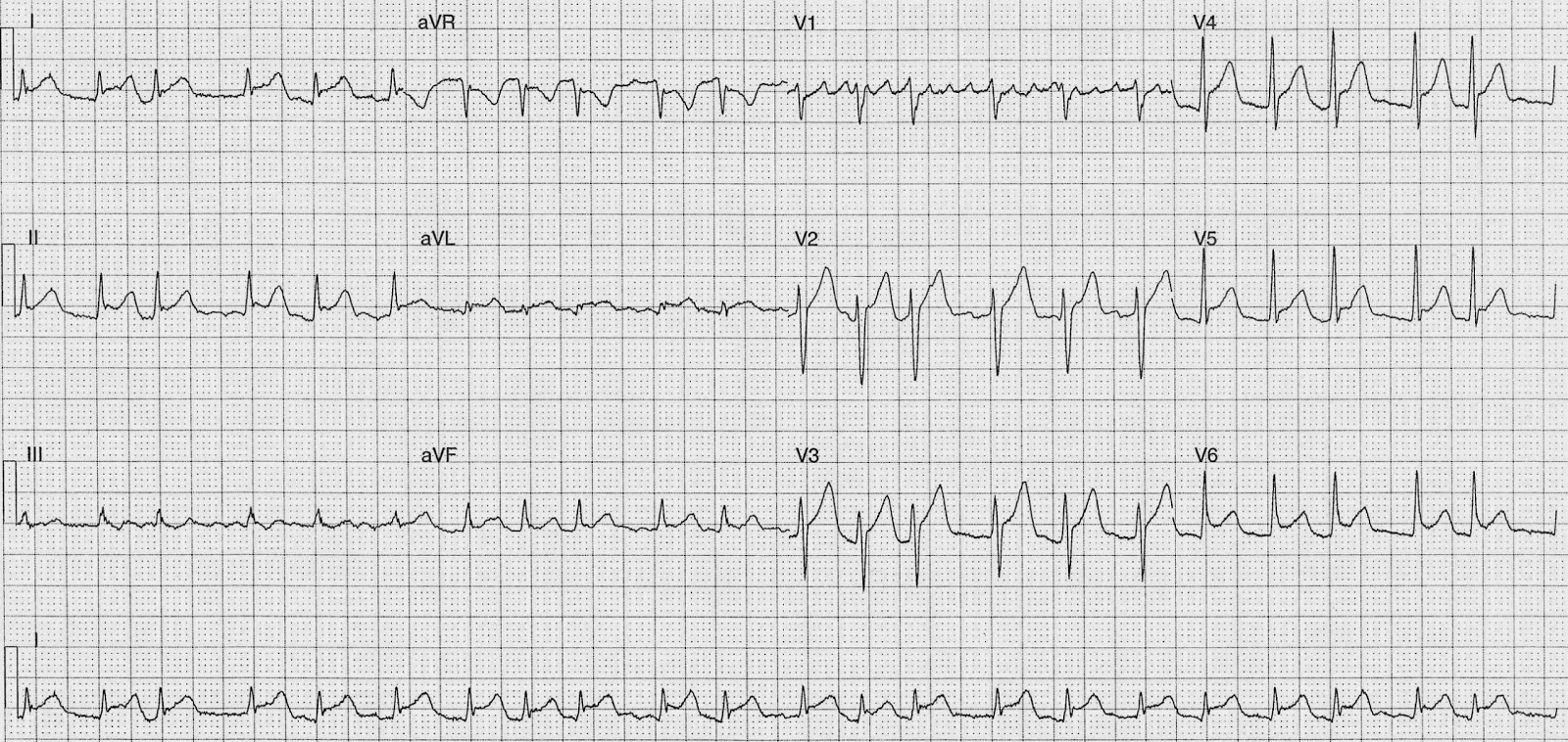 ECG of the Week: ECG of the Week - 18th May 2015 - Interpretation