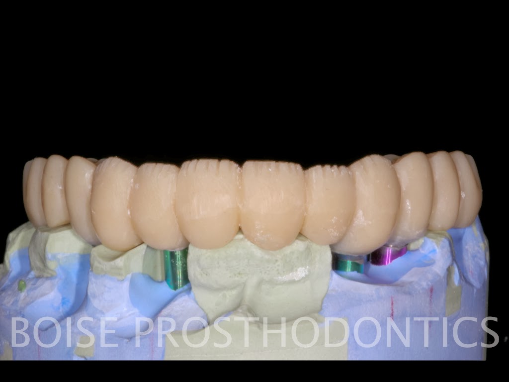 Boise Idaho Prosthodontics: Maxillary Implant Rehab Provisional, Index ...