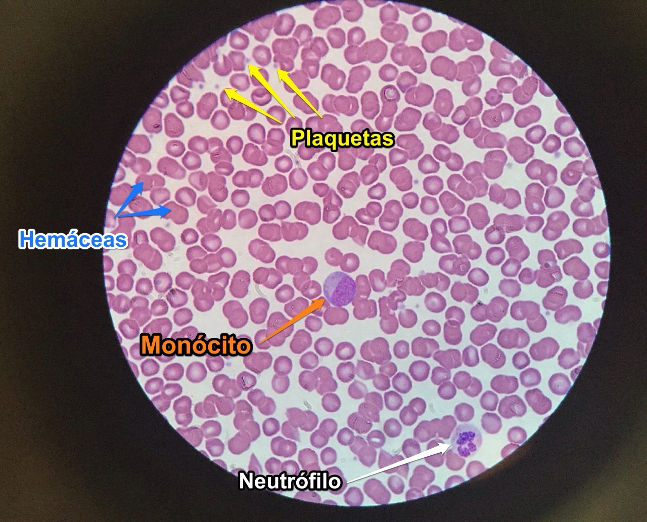 HISTOLOGIA90: MORFOLOGIA DAS CÉLULAS DO SANGUE E LEUCEMIAS