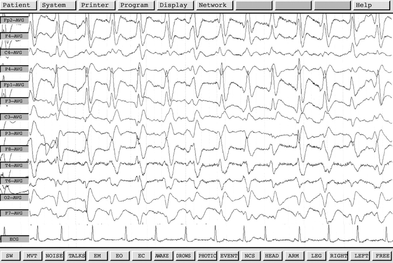 NeuroAnatomía Dr. William Ganem: Parálisis supranuclear progresiva ...