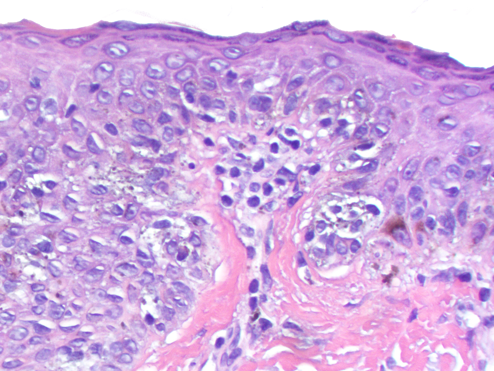 VIRTUAL GRAND ROUNDS IN DERMATOLOGY 2.0: Whose Nose Needs Mohs?