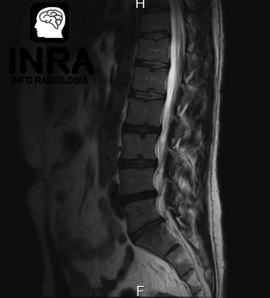 INRA: Nodulo de schmorl