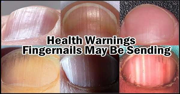 Do Not Ignore 5 Health Warnings Your Fingernails May Be Sending ... Do Not Ignore 5 Health Warnings Your Fingernails May Be Sending ...