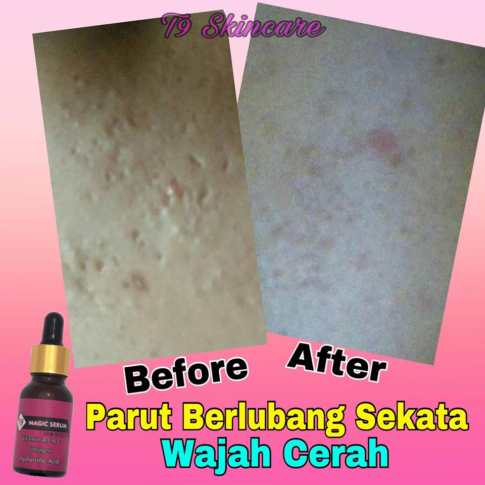 T9 SKINCARE: SERUM HILANG PARUT BERLUBANG & PARUT HITAM DENGAN BERKESAN