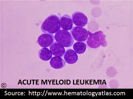 Lab Atlas: Acute Myeloid Leukemia