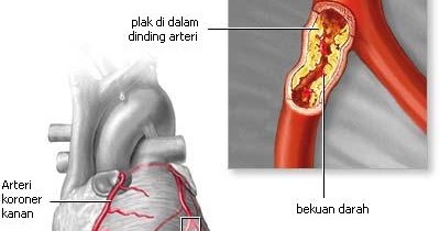 Klinik Bekam, Akupuntur dan Herbal Blora: Terapi Fasdu untuk jantung