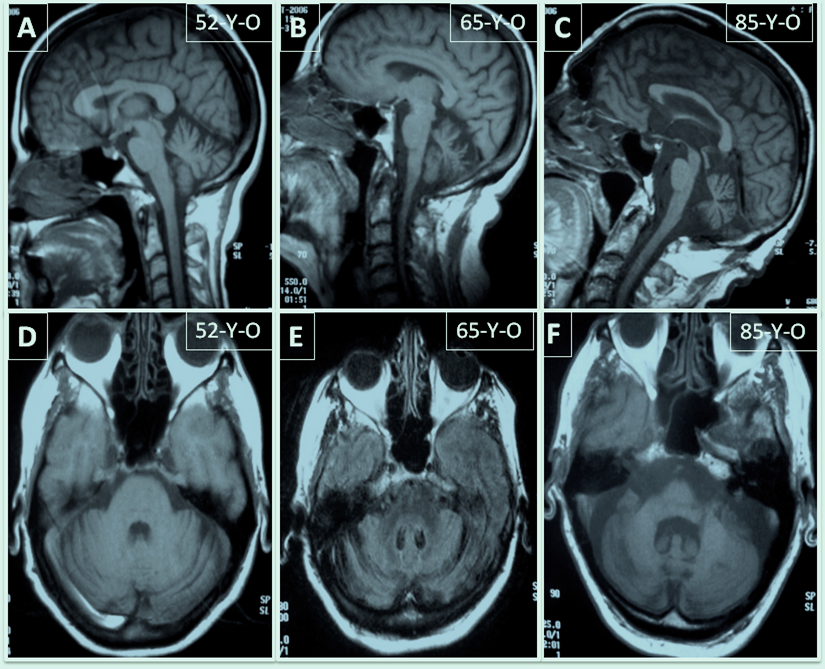 Ataxias Galicia: Así es la SCA36: la extraña enfermedad de la Costa da ...