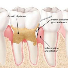 Wentz Orthodontics: Eat Better, Beat plaque