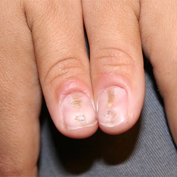 magical beauty: Nails abnormalities & their causes!