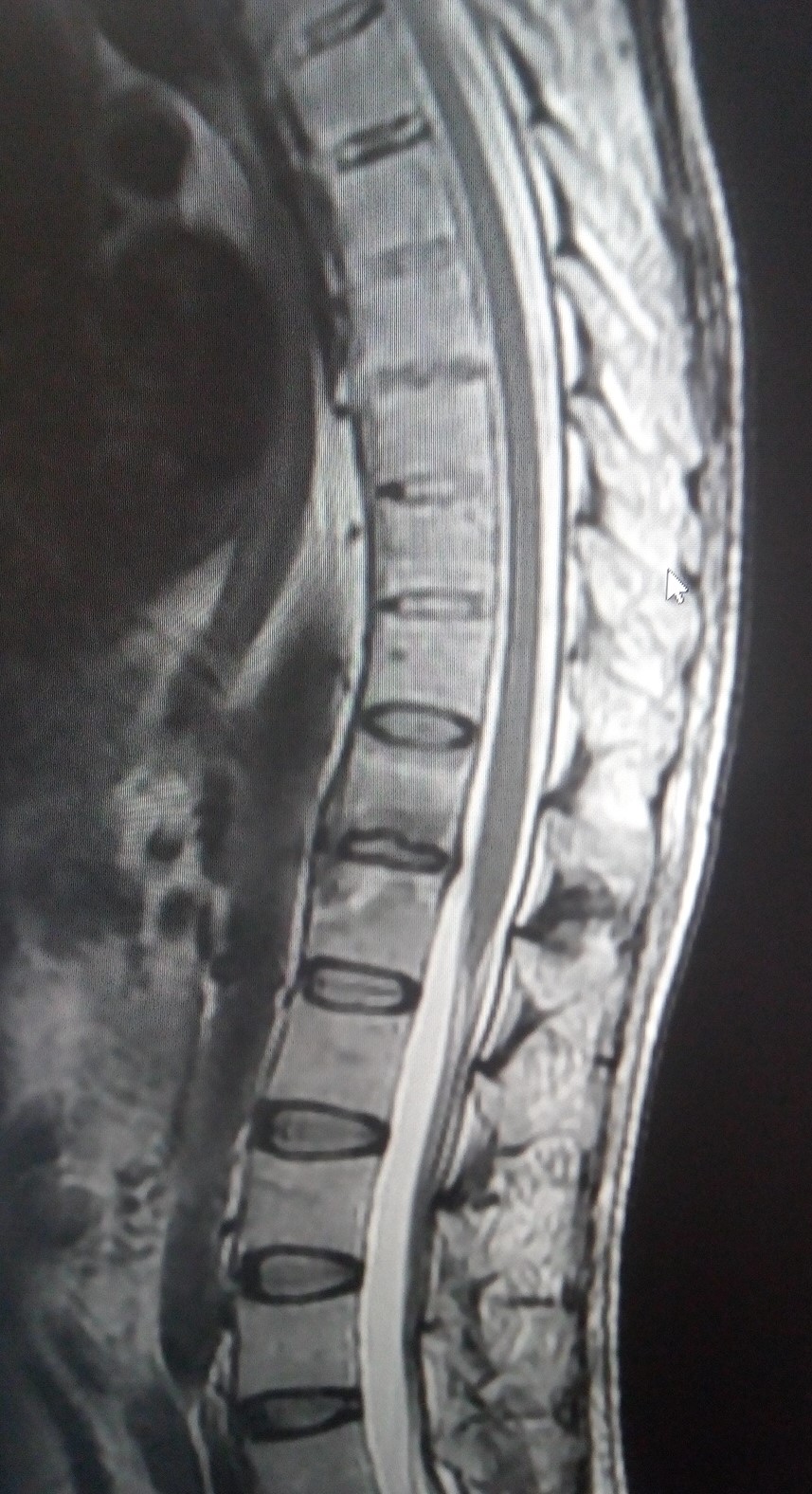 Ankylosing Spondylitis: MRI - Sumer's Radiology Blog