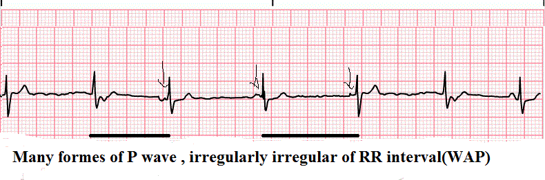 KHMER MEDECINE: Wandering Atrial pacemaker