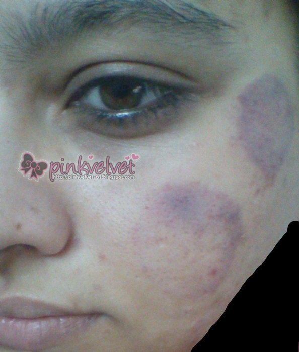 Pengalaman Buat Bekam Seri Wajah | p i n k v e l v e t