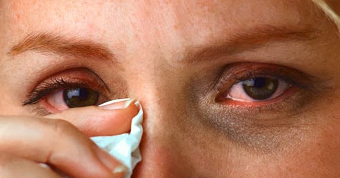 How To Deal With Allergic Shiners