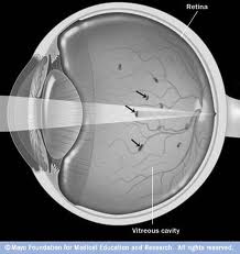Eye 2 Eye Optometrists: Eye Floaters (Benign)