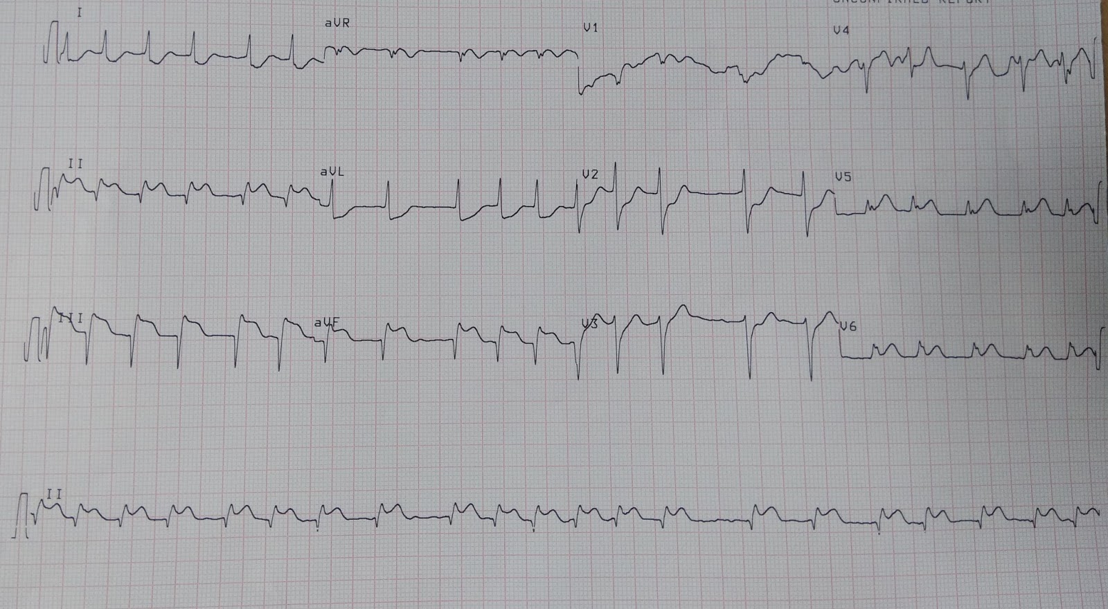 Cardiology window: Atrial fibrillation in a patient with inferior wall ...