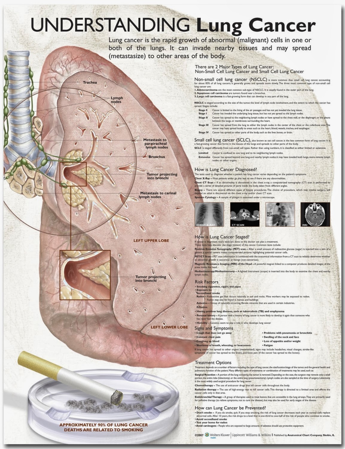 Really Understanding Lung Cancer | - Blog Hanz