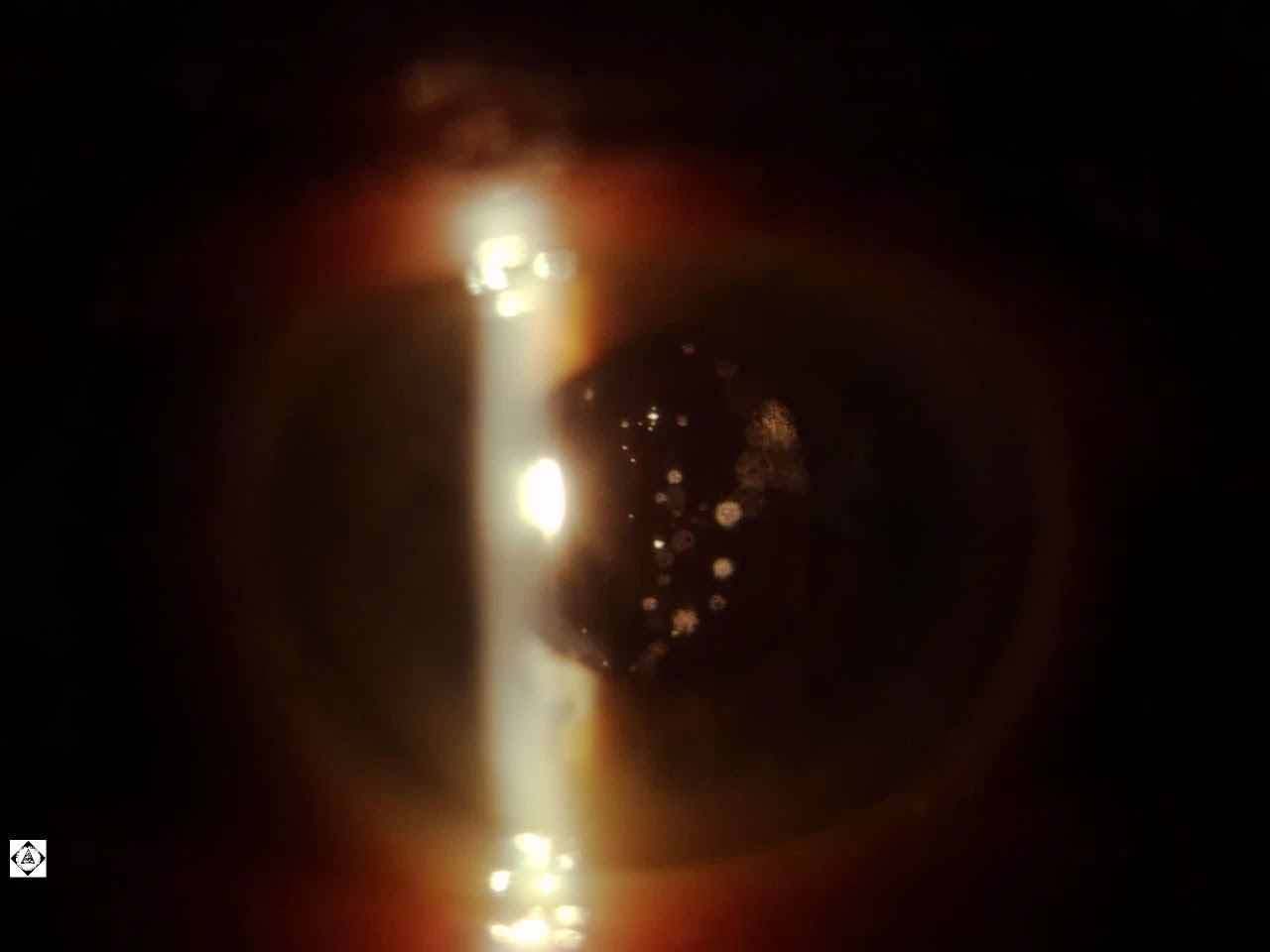 Sonoran Desert Eye Center: ASTEROID HYALOSIS