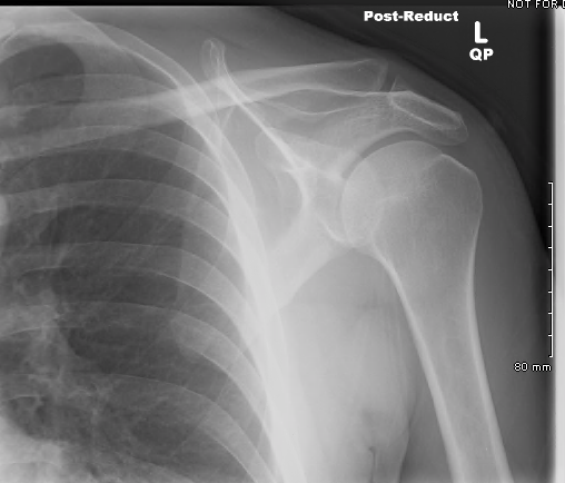 Shoulder and Elbow Surgery: Locked scapula syndrome (or scapular ...